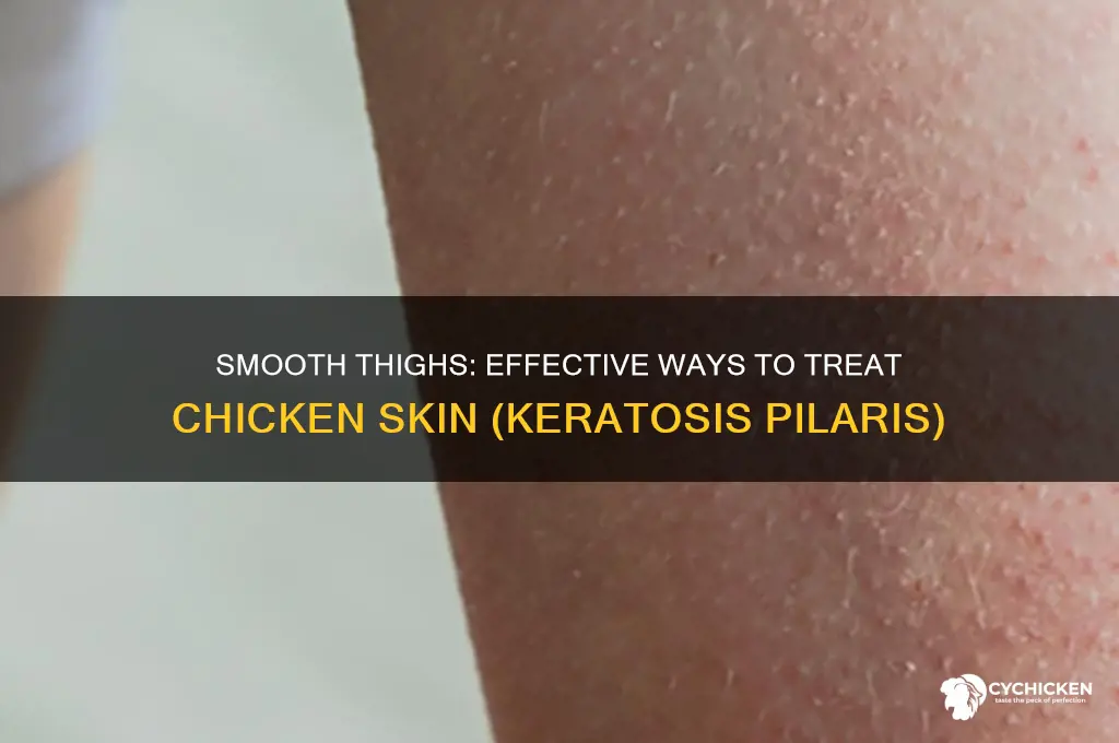 Smooth Thighs: Effective Ways To Treat Chicken Skin (Keratosis Pilaris ...