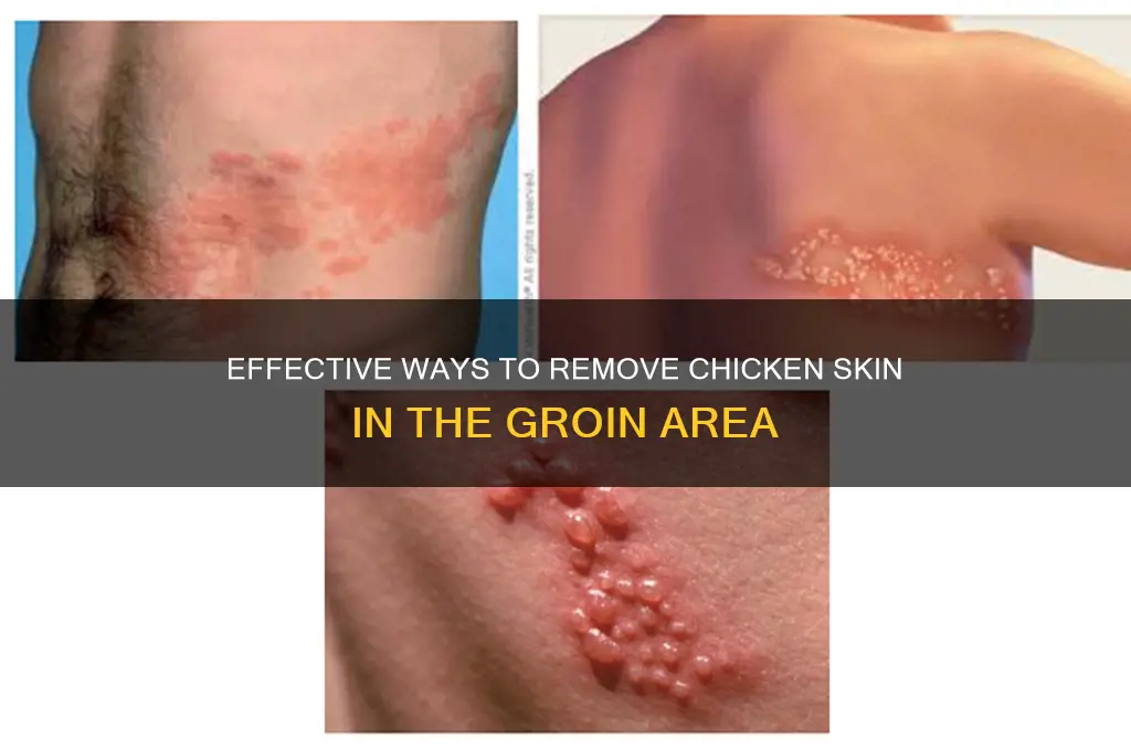Effective Ways To Remove Chicken Skin In The Groin Area | CyChicken