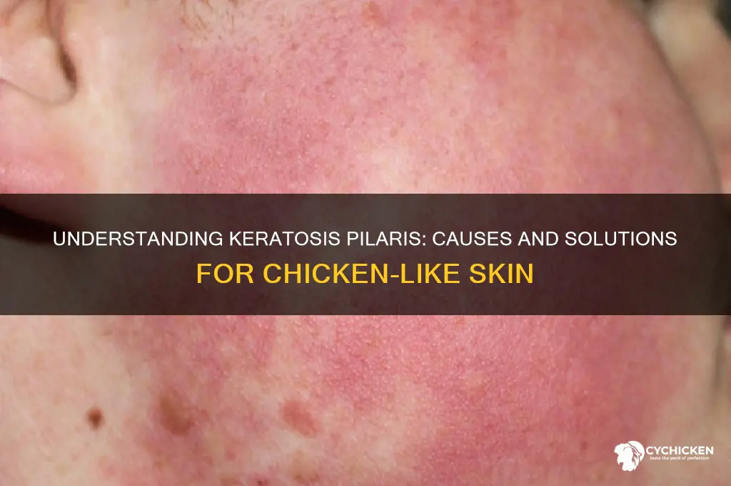 Understanding Keratosis Pilaris: Causes And Solutions For Chicken-Like ...