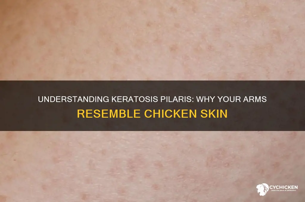Understanding Keratosis Pilaris: Why Your Arms Resemble Chicken Skin ...